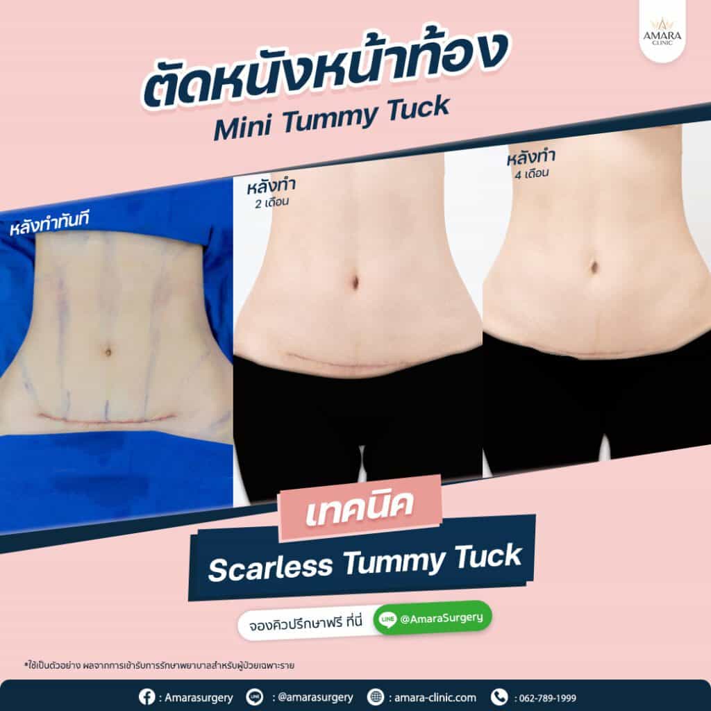 Tummy Tuck เก็บพุงย้วย ผิวยับ ให้ตึงเป๊ะ เหมือนได้เกิดใหม่! - Amara Clinic