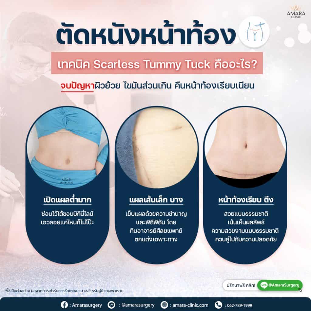 Tummy Tuck เก็บพุงย้วย ผิวยับ ให้ตึงเป๊ะ เหมือนได้เกิดใหม่! - Amara Clinic